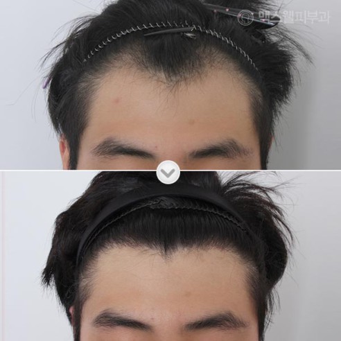 Before and After - Maxwell Hair Clinic