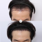 Before and After - Maxwell Hair Clinic