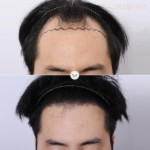 Before and After - Maxwell Hair Clinic