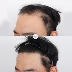 Before and After - Maxwell Hair Clinic