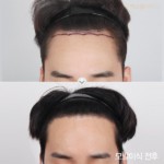 Before and After - Maxwell Hair Clinic