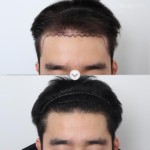 Before and After - Maxwell Hair Clinic