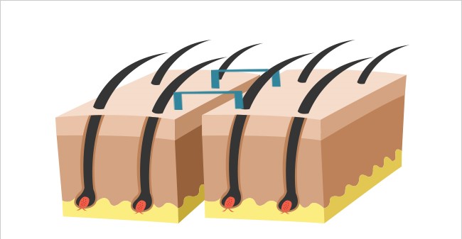 Hair transplant scars - Maxwell Hair Clinic